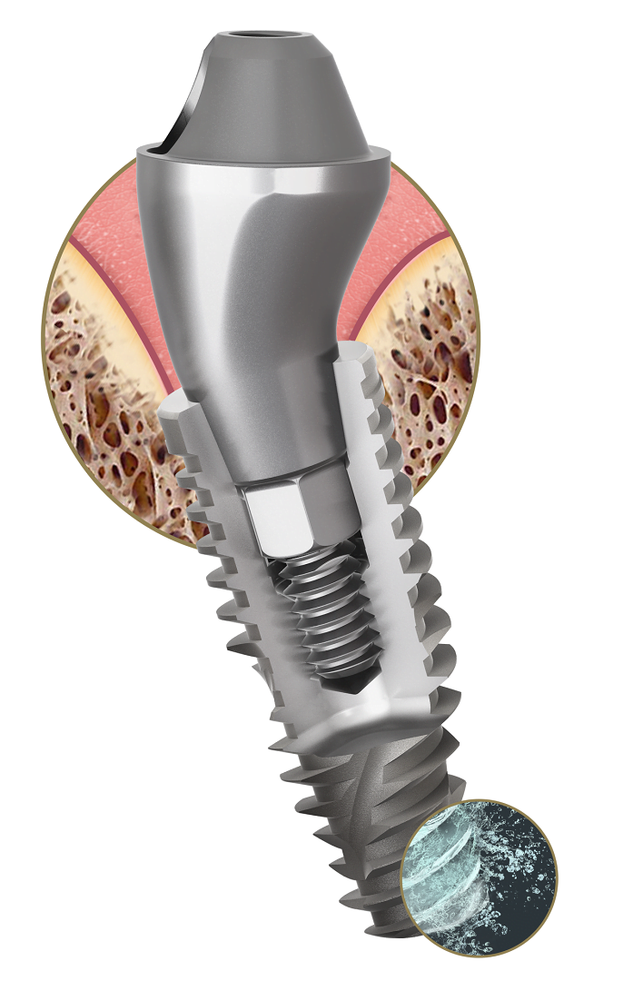 NeoArch Full Arch All-on-X – SC Dental Supply Sdn. Bhd.